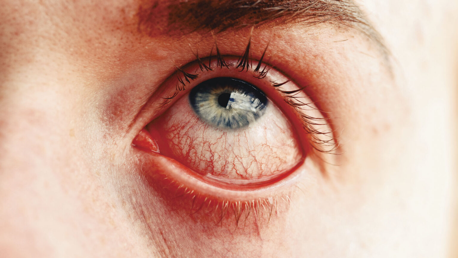 5 Claves para Entender el Desprendimiento de Retina